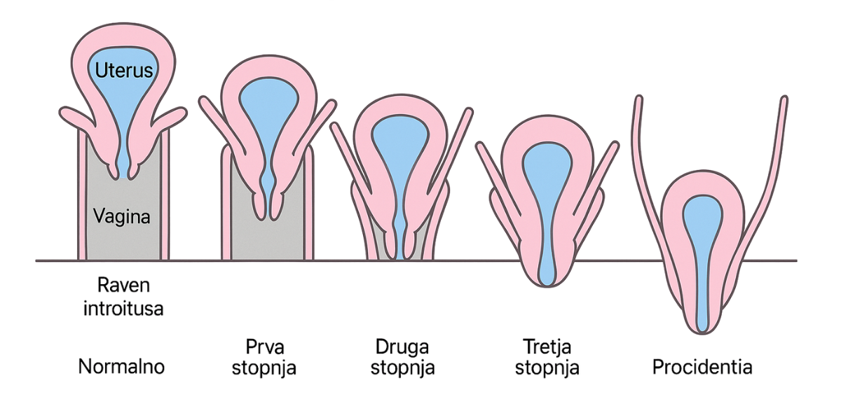 Prolaps maternice - Klinika BUT
